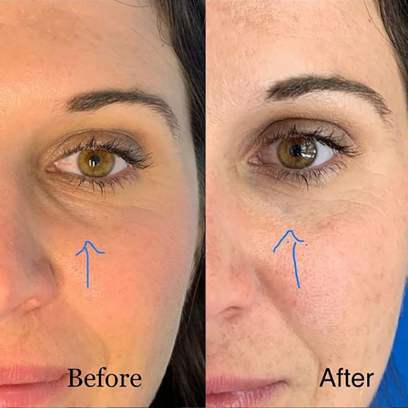 Tear Trough Filler 1 Barbarino Surgical Arts